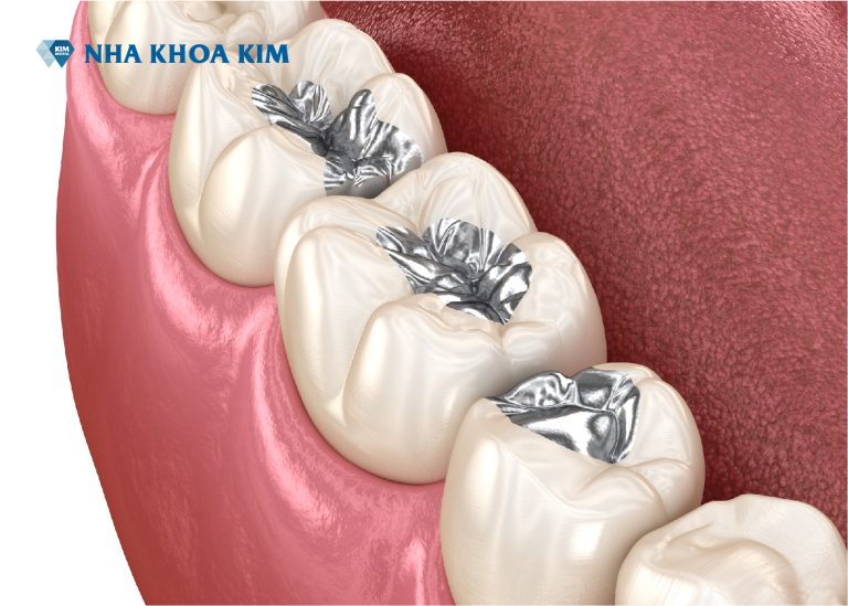 Trám răng là gì? Cách vệ sinh răng miệng đúng sau trám răng