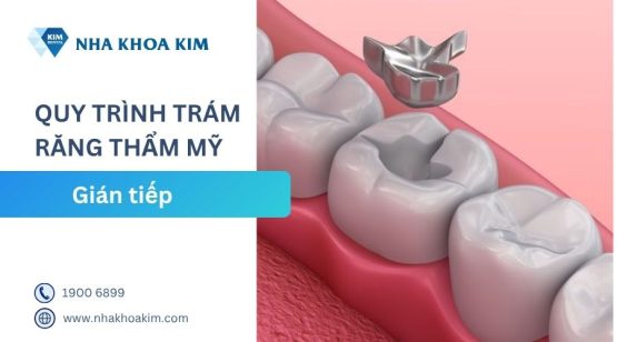 Trám răng là gì? Quy trình trám răng thẫm mỹ chuẩn y khoa