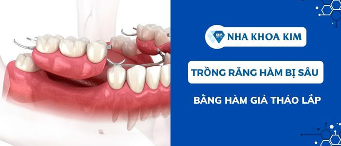 Trồng răng hàm bị sâu giá bao nhiêu 1 cái?