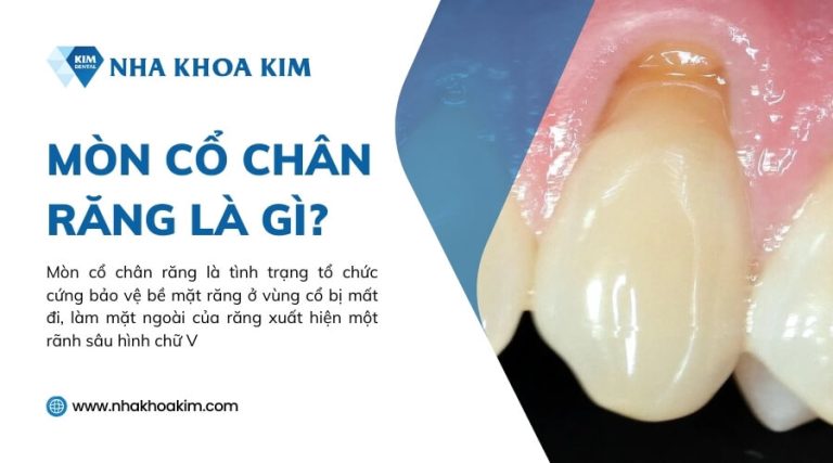 Mòn cổ chân răng là gì? Nguyên nhân và cách điều trị