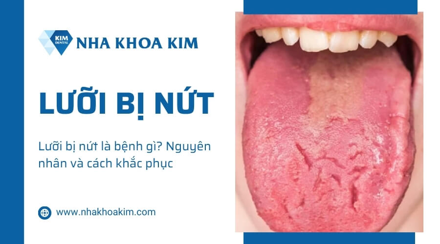 Lưỡi Bị Nứt Là Bệnh Gì Nguyên Nhân Và Cách Khắc Phục