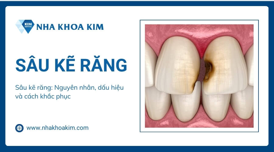 Sâu kẽ răng: Nguyên nhân, dấu hiệu và cách khắc phục