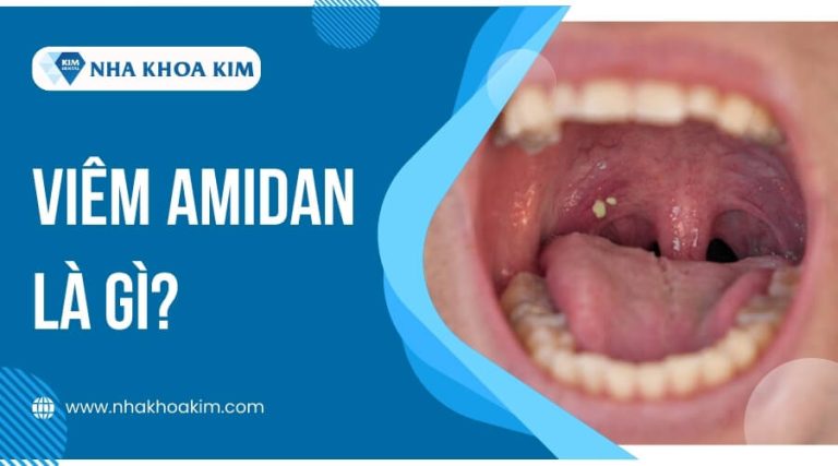 Viêm amidan là gì? Nguyên nhân, dấu hiệu và cách chữa trị