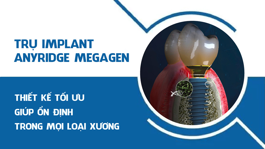 Trụ Implant Anyridge MegaGen - Thiết kế tối ưu giúp ổn định trong mọi ...