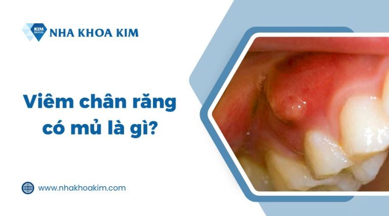 Viêm chân răng có mủ là bệnh gì? Cách điều trị ra sao?